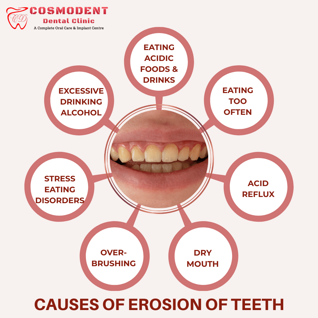 Erosion of teeth: Causes, symptoms & prevention